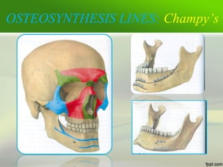 Case of trauma(Mandibular Left Parasymphysis and Right Angle Fracture ...