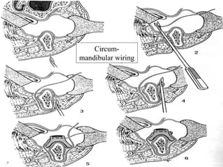 Case of trauma(Mandibular Left Parasymphysis and Right Angle Fracture ...