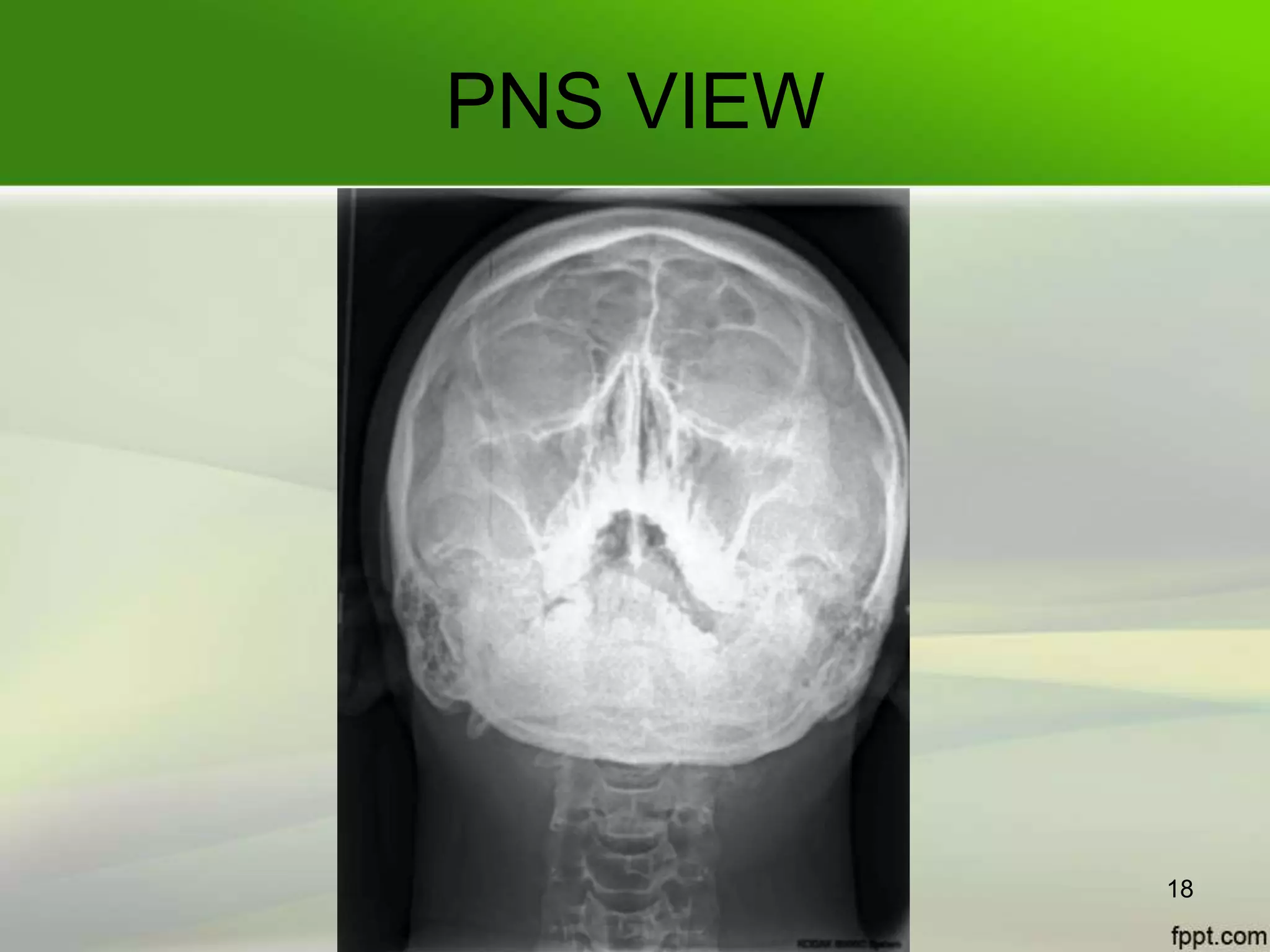 Case of mandibular parasymphysis and angle fracture | PPT