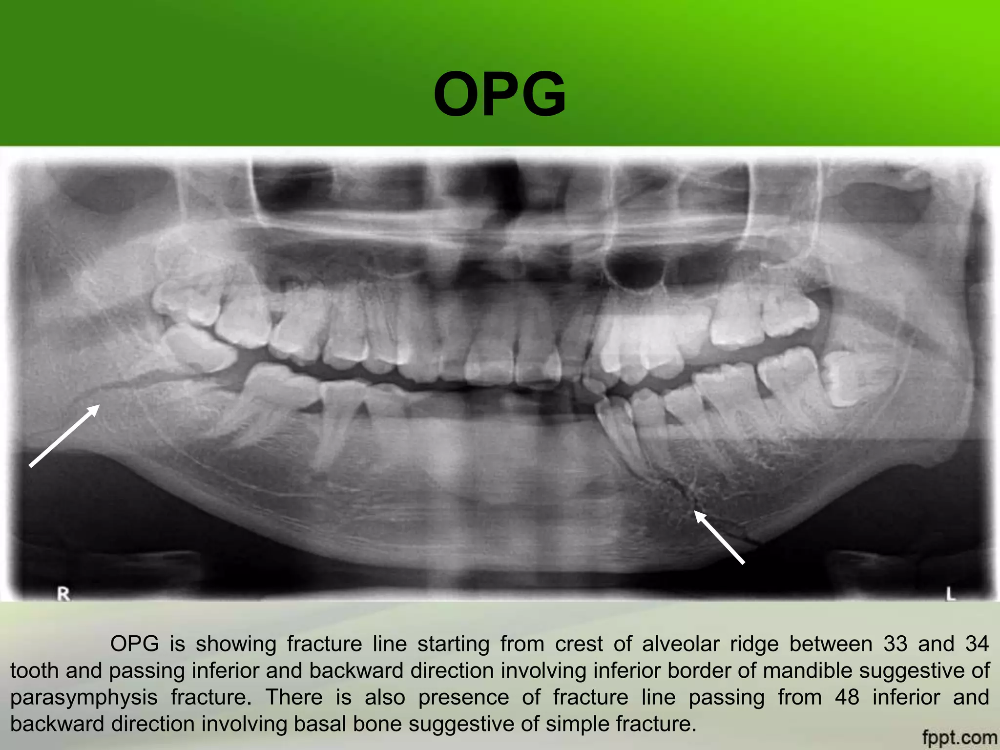 Case of mandibular parasymphysis and angle fracture | PPT