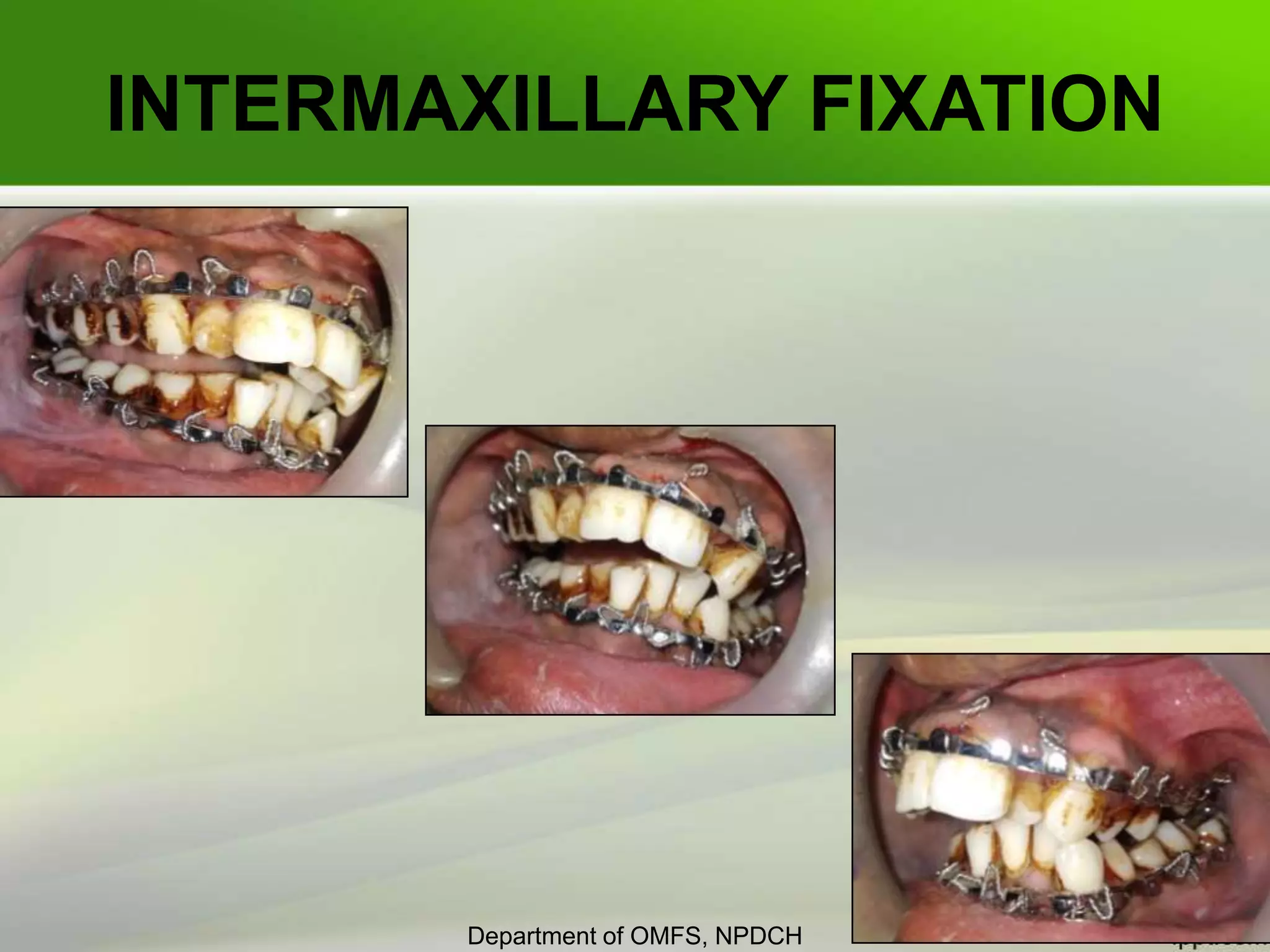 Case of mandibular parasymphysis and angle fracture | PPT