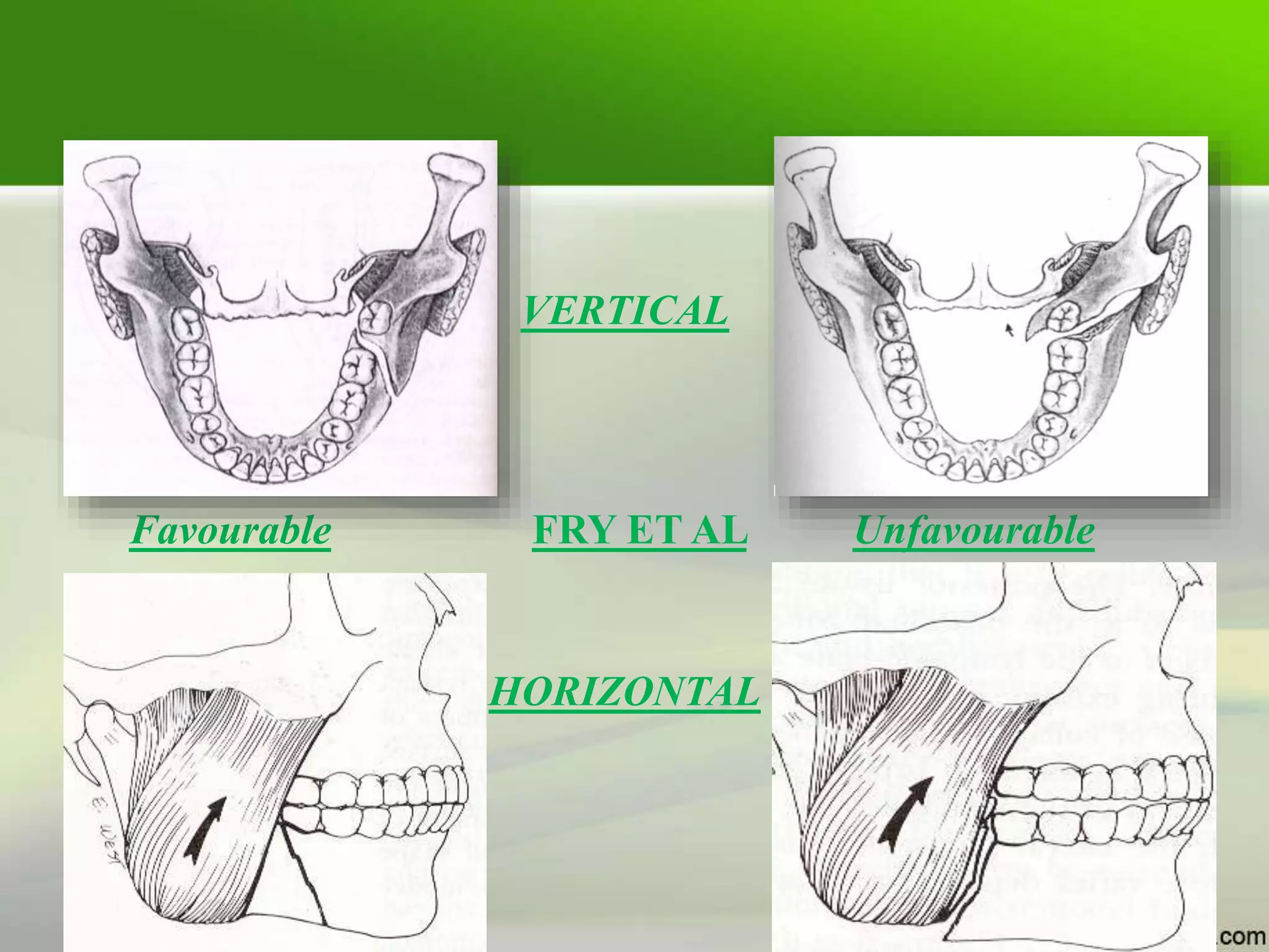 Case of mandibular parasymphysis and angle fracture | PPT | Death ...