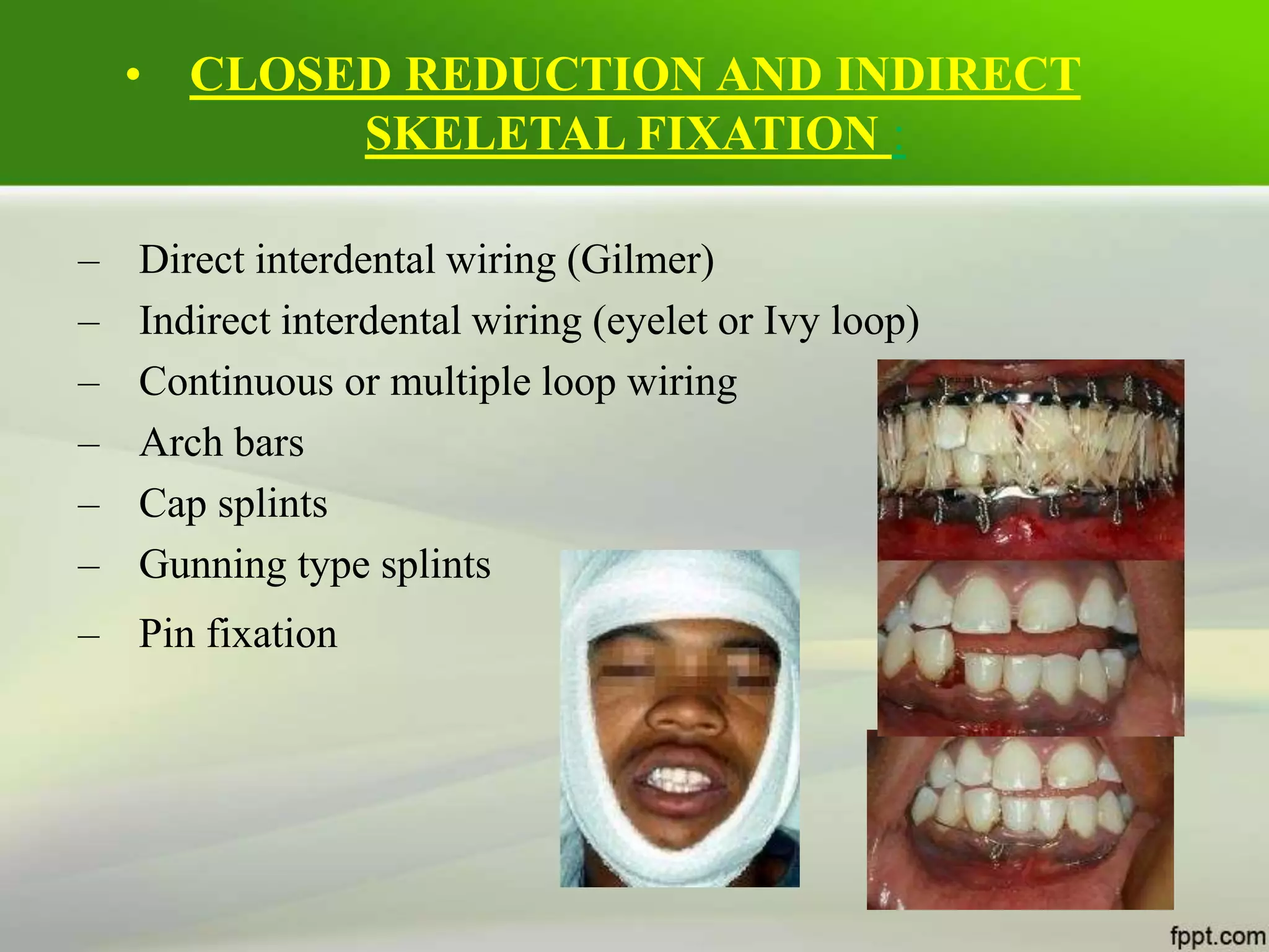 Case of mandibular parasymphysis and angle fracture | PPT