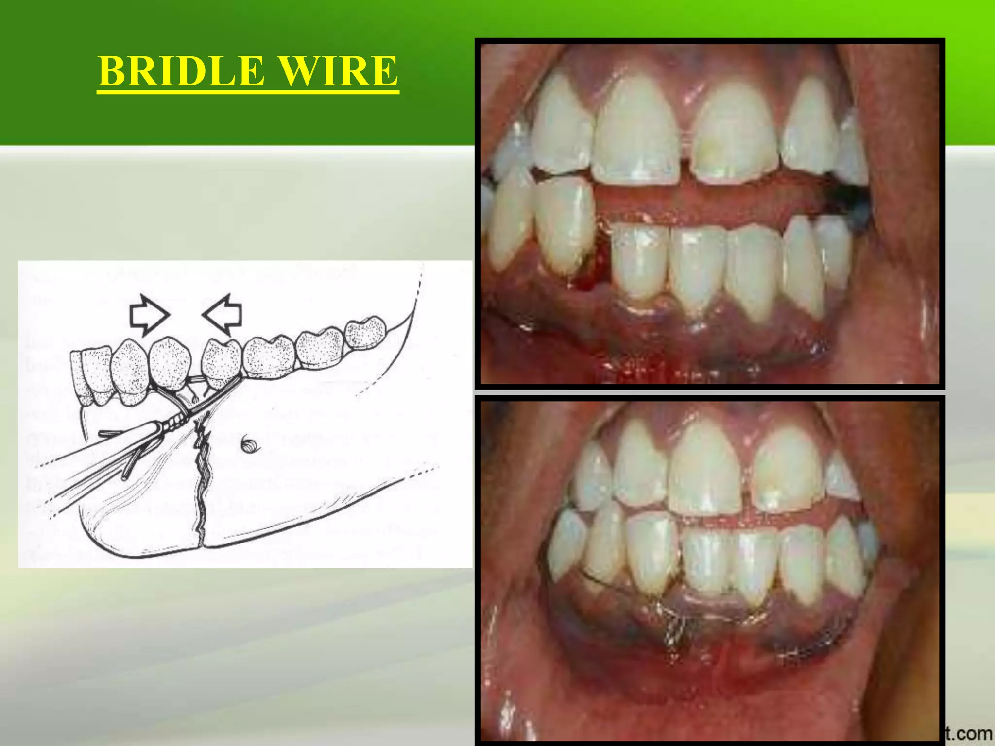 Case of mandibular parasymphysis and angle fracture | PPT