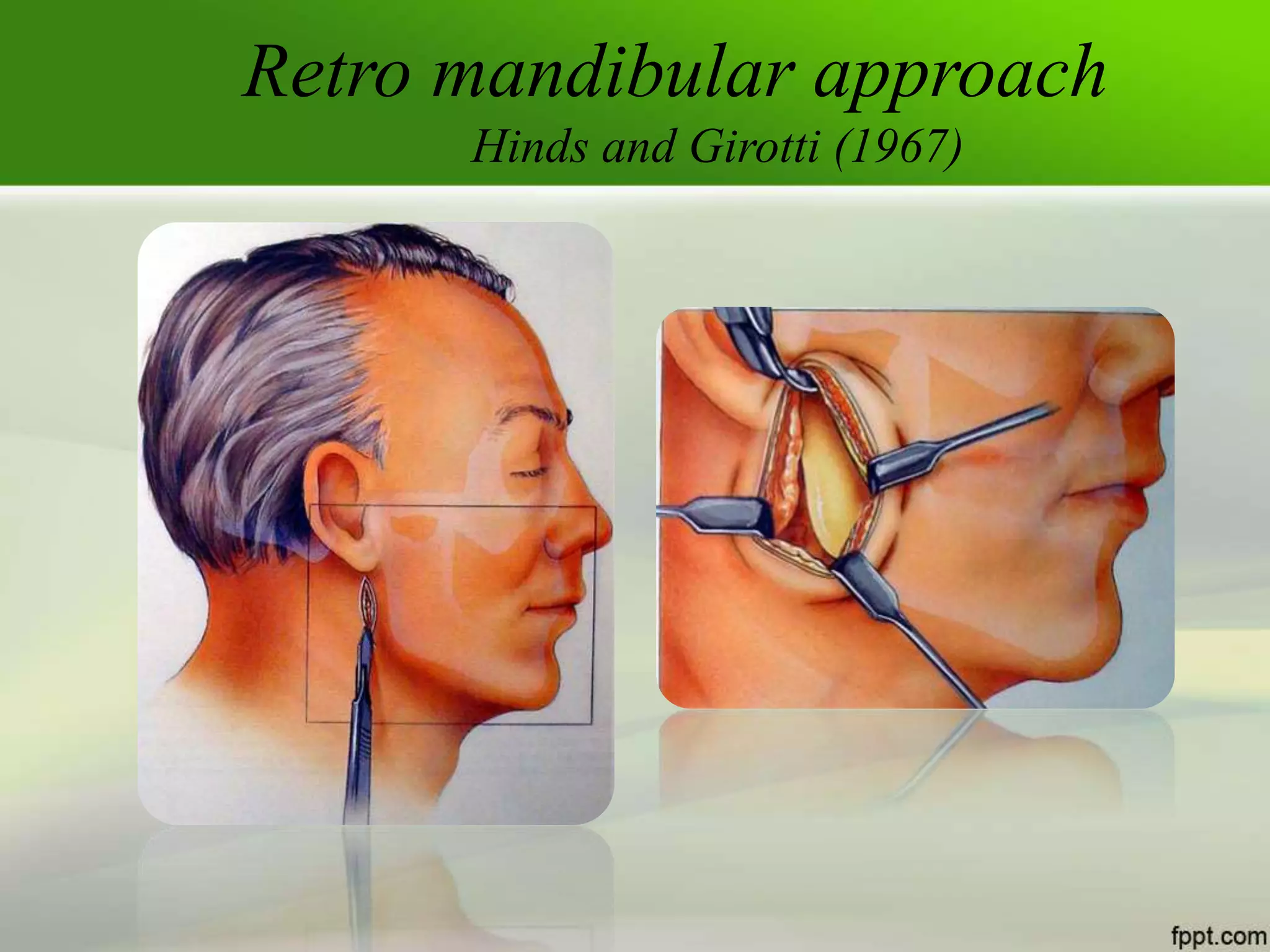 Case of mandibular parasymphysis and angle fracture | PPT