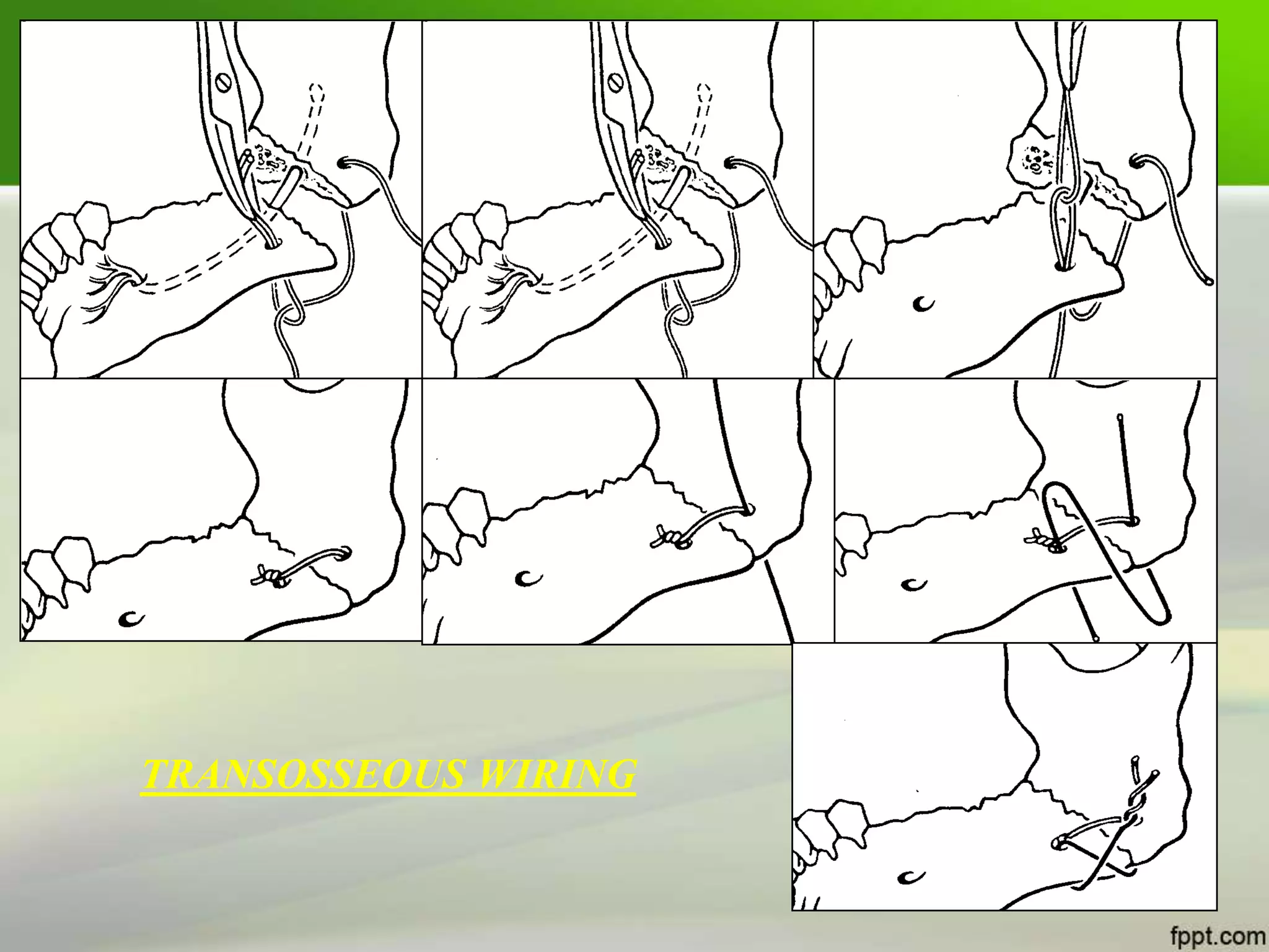 Case of mandibular parasymphysis and angle fracture | PPT