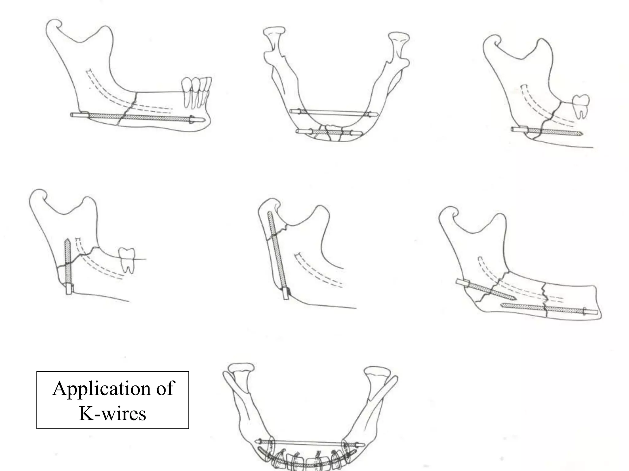 Case of mandibular parasymphysis and angle fracture | PPT