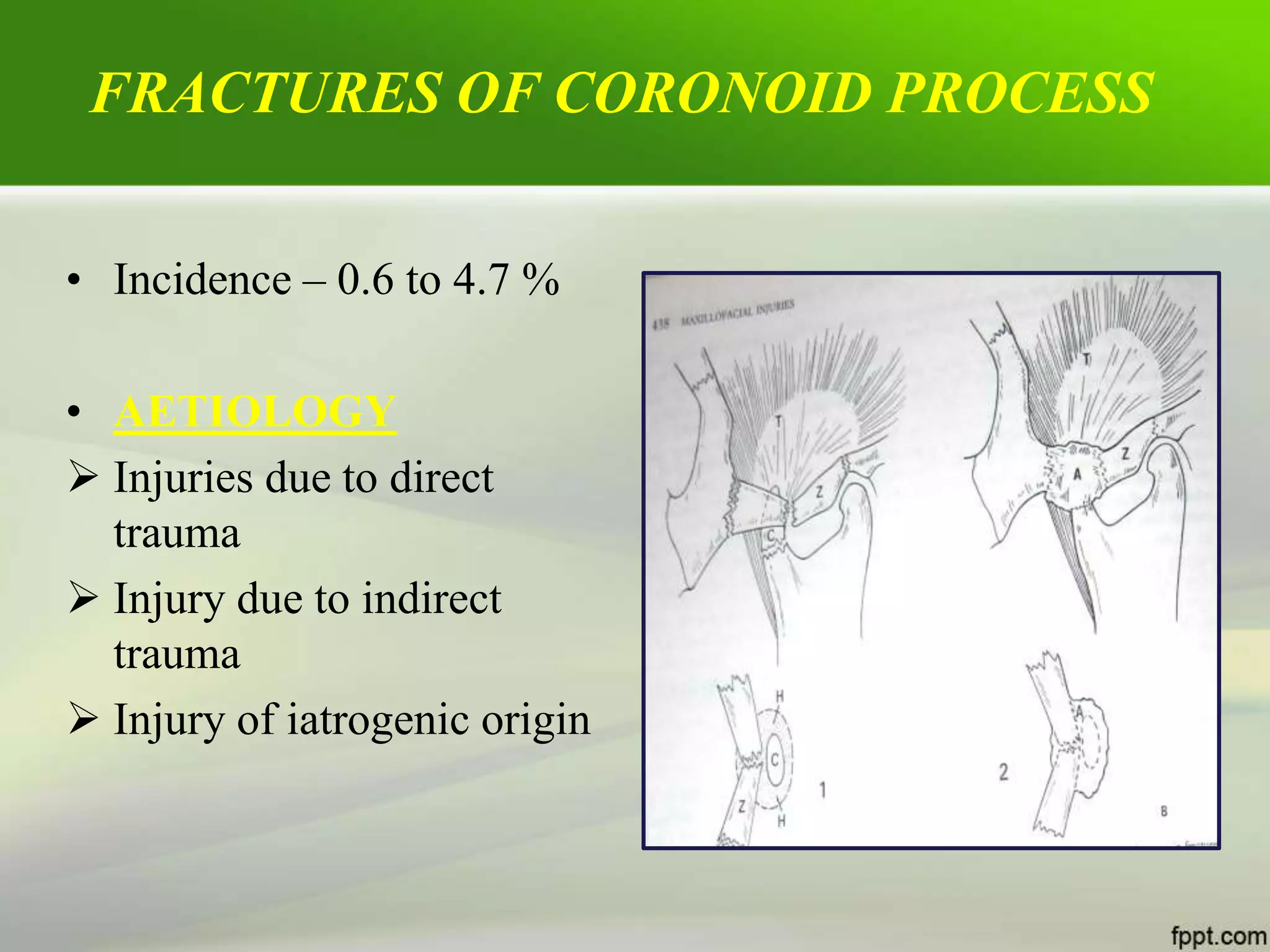 Case of mandibular parasymphysis and angle fracture | PPT