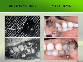 Case of mandibular parasymphysis and angle fracture | PPT