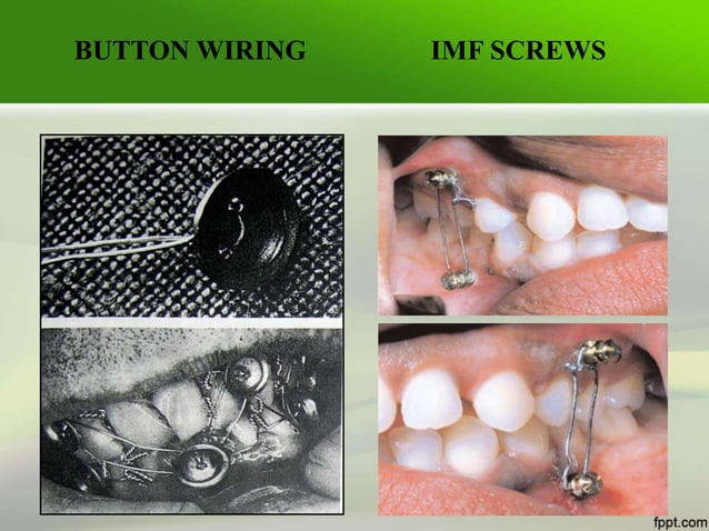 Case of mandibular parasymphysis and angle fracture | PPT | Death ...