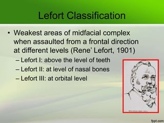 Case of Trauma- Bilateral body of mandible fracture and Lefort I ...