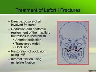 Case of Trauma- Bilateral body of mandible fracture and Lefort I ...