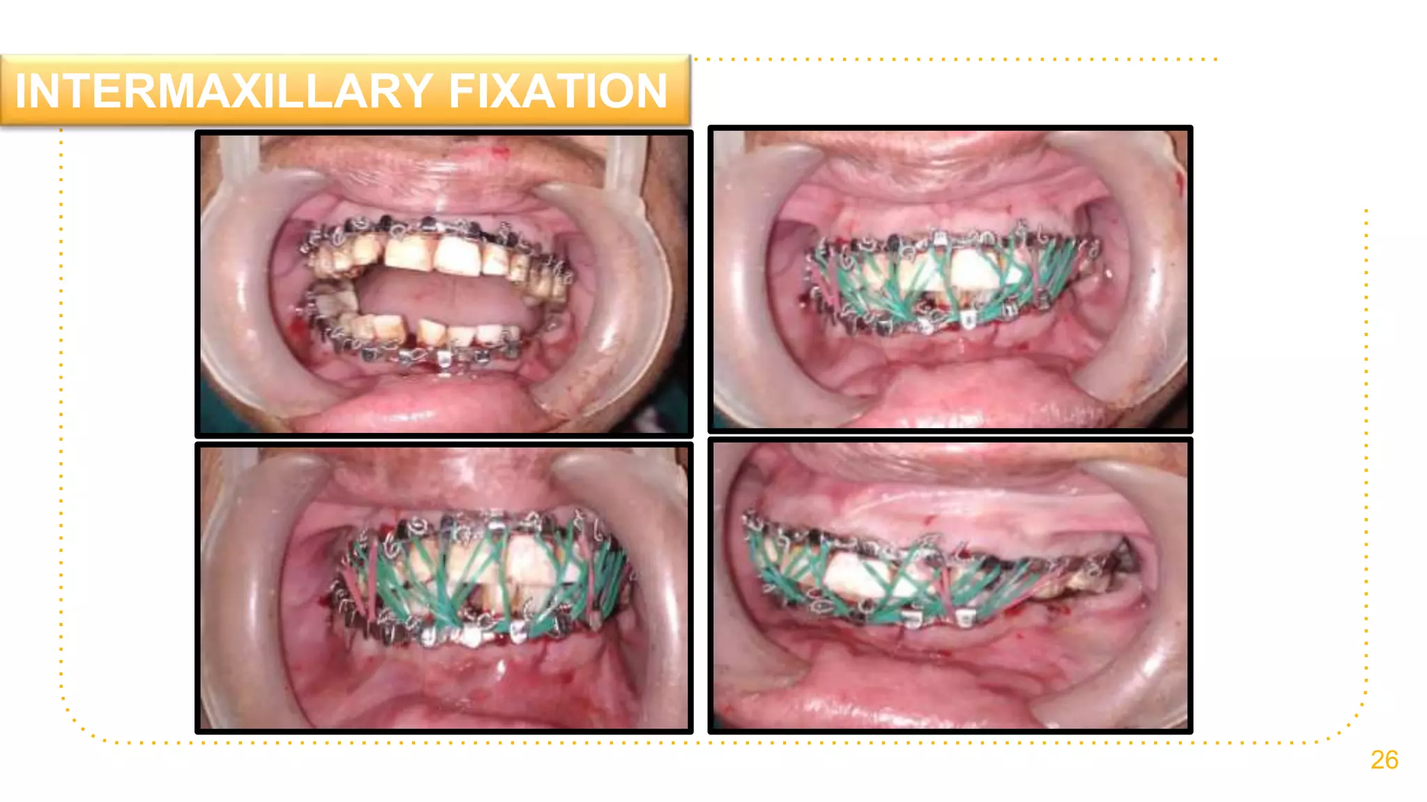 Case of Trauma- Bilateral Condylar and Parasymphysis Fracture | PPTX