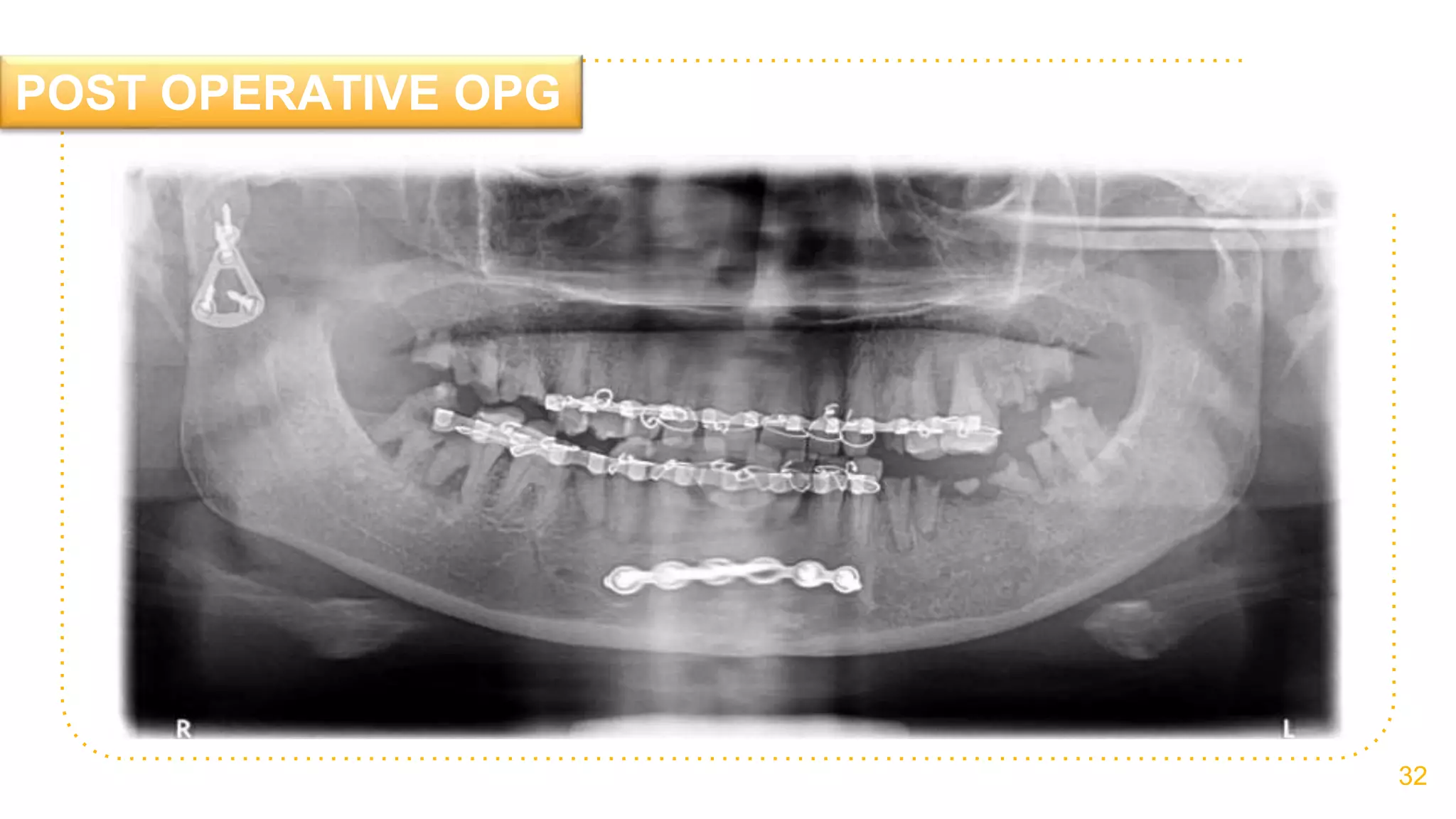 Case of Trauma- Bilateral Condylar and Parasymphysis Fracture | PPTX
