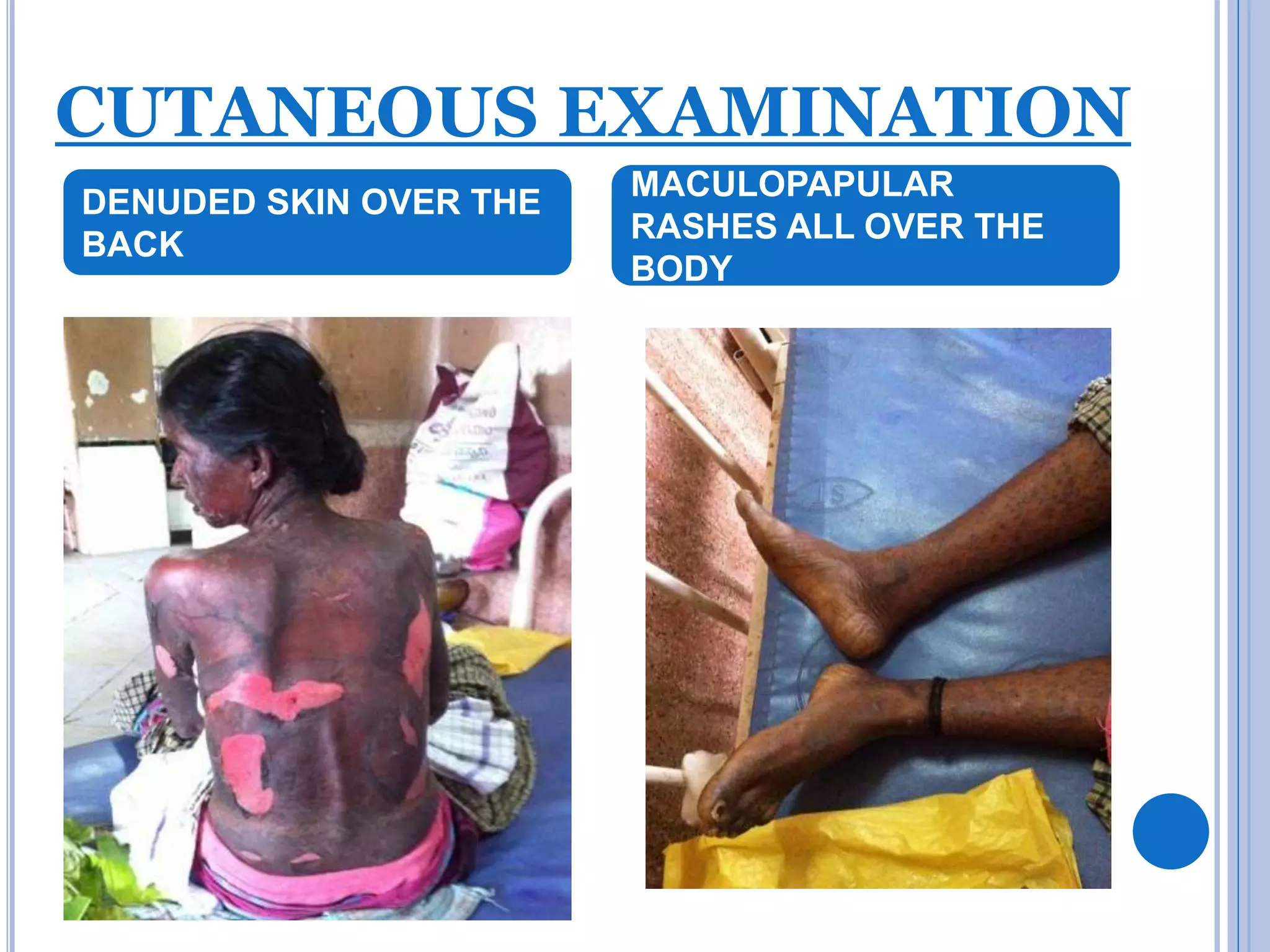 Case presentation on toxic epidermal necrolysis | PPTX