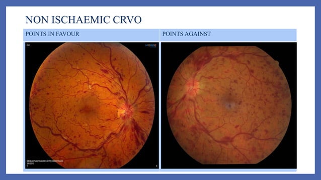 Crvo case presentation.pptx
