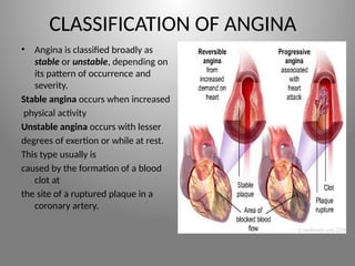 CASE PRESENTATION OF ANGINA PECTORIS FOR NURSING STUDENTS | PPT