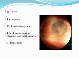 Case presentaion- Kerato-uveitis-Dr. Vijay pratap singh | PPTX