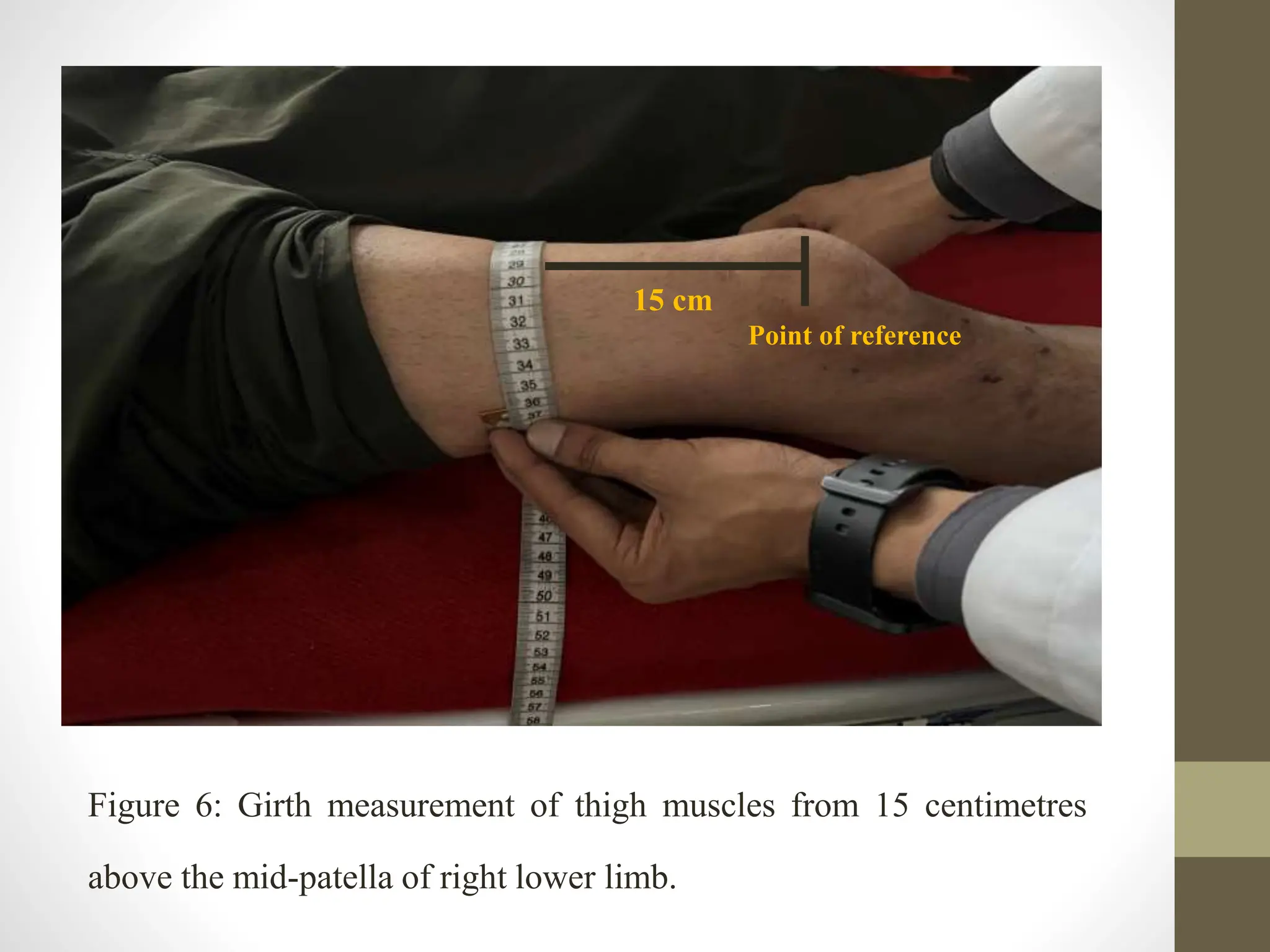 Avascular Necrosis (AVN) of Right Hip Joint : A case presentation | PPTX