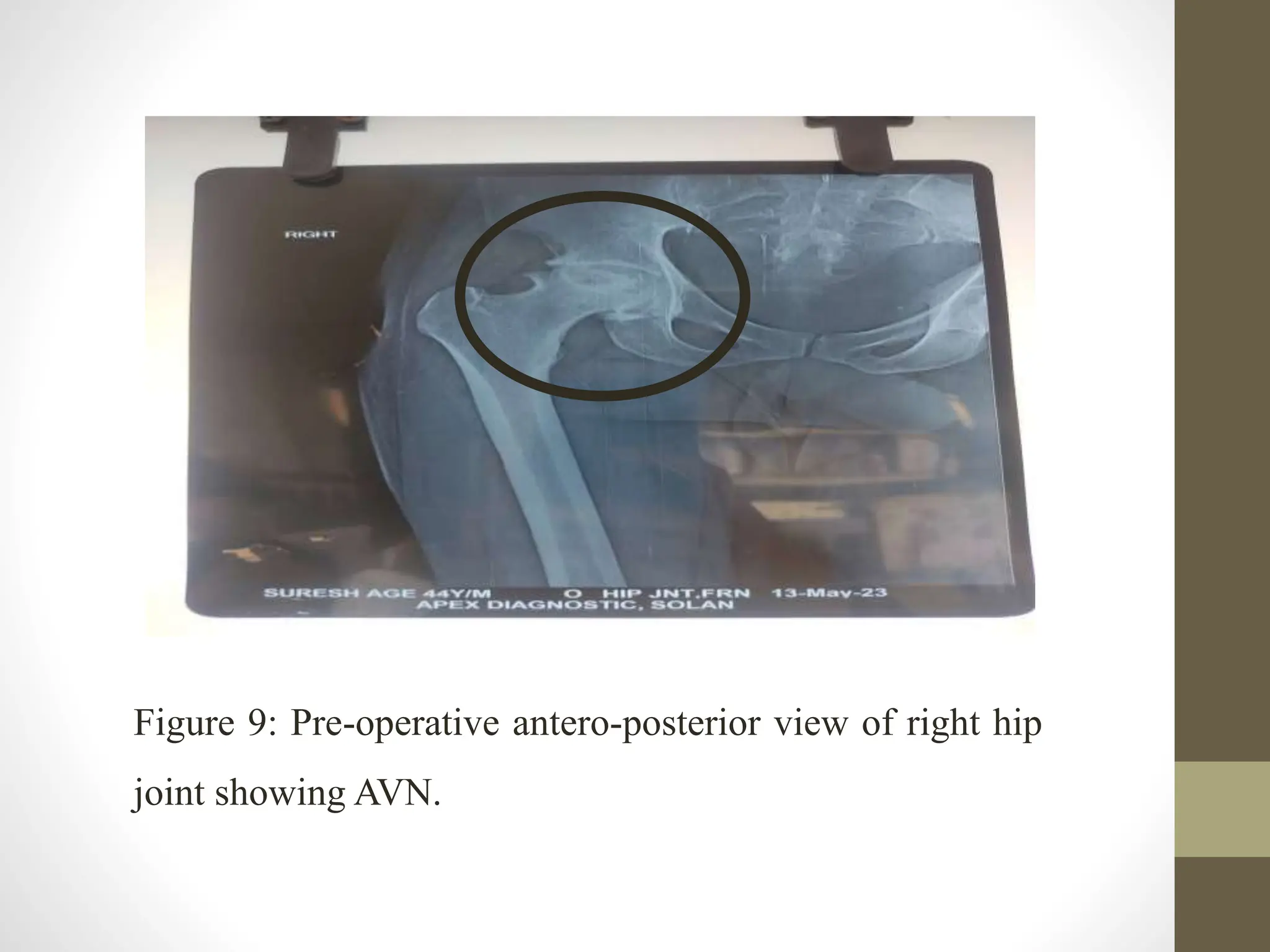 Avascular Necrosis (AVN) of Right Hip Joint : A case presentation | PPTX