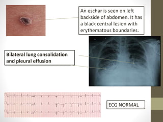 Scrub Typhus | PPTX | Infectious Diseases | Diseases and Conditions