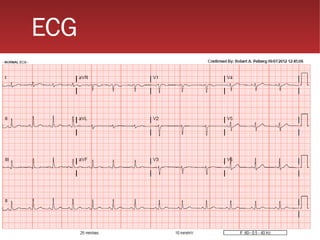 Ecg Pericardial Effusion