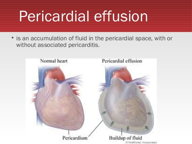 Pericardial effusion- case report and review