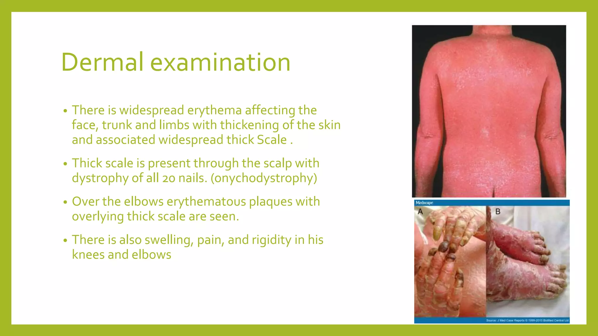 Case presentation in Dermatology erythrodermic psoriasis | PPTX | Blood ...