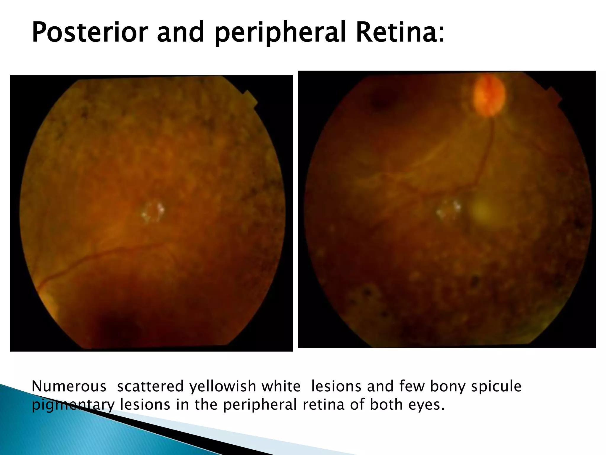 Case presentation-Retinitis Pigmentosa Albecanse | PPTX
