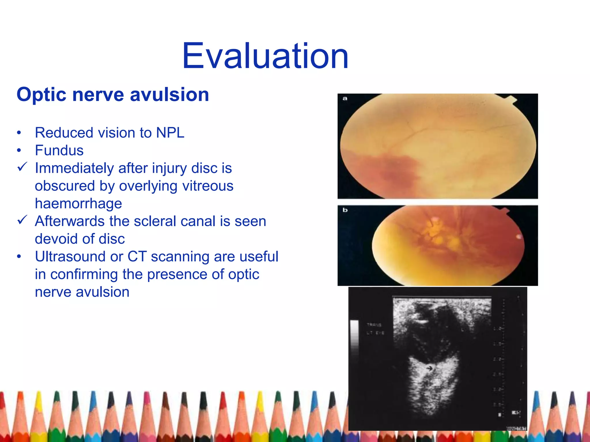 traumatic optic neuropathy | PPTX