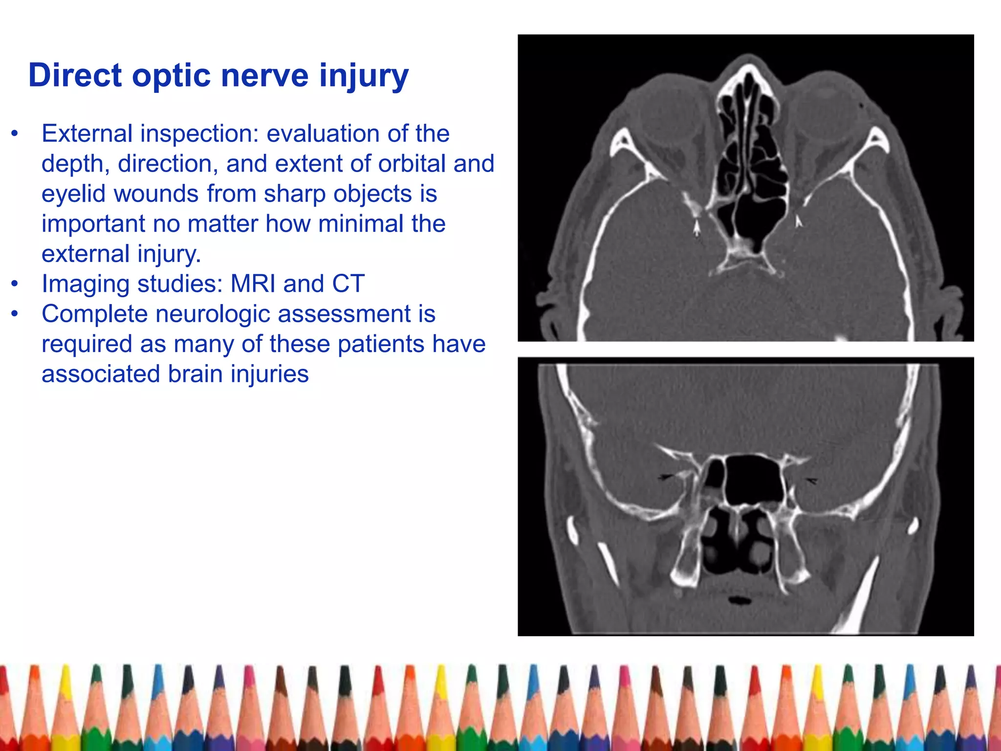 traumatic optic neuropathy | PPTX