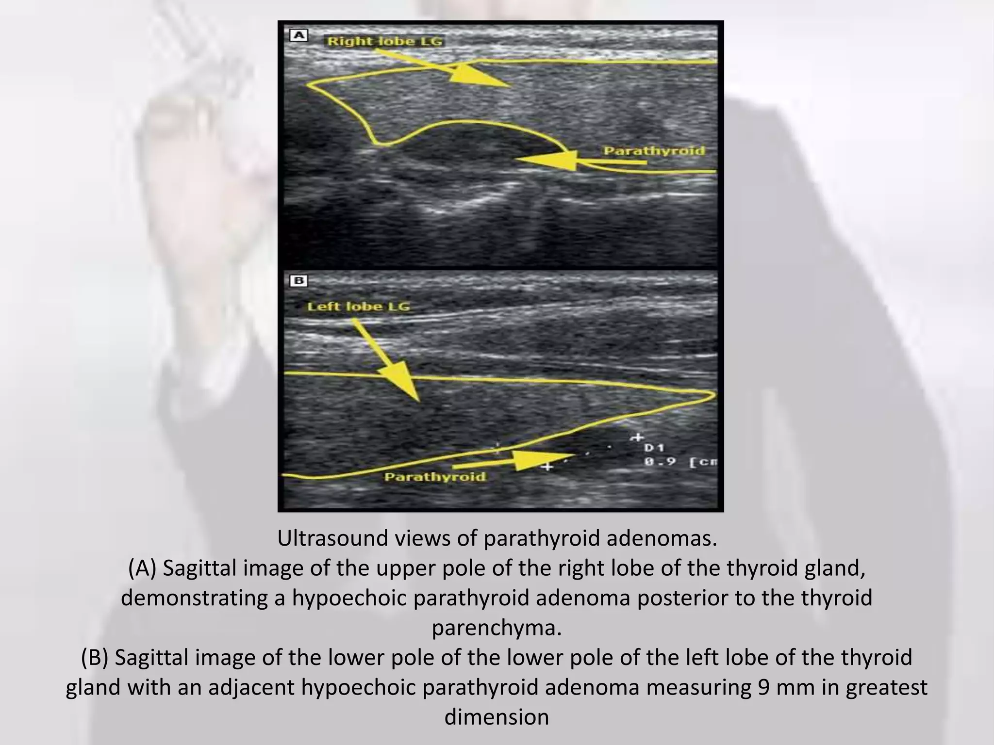 Case presentation of primary hyperparathyroidism | PPTX