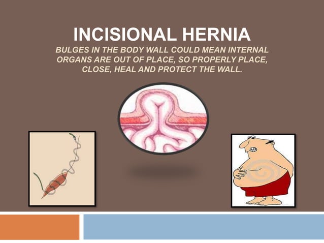 Incisional Hernia | PPTX