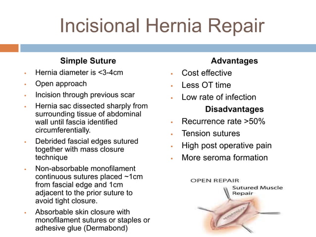 Incisional Hernia | PPTX