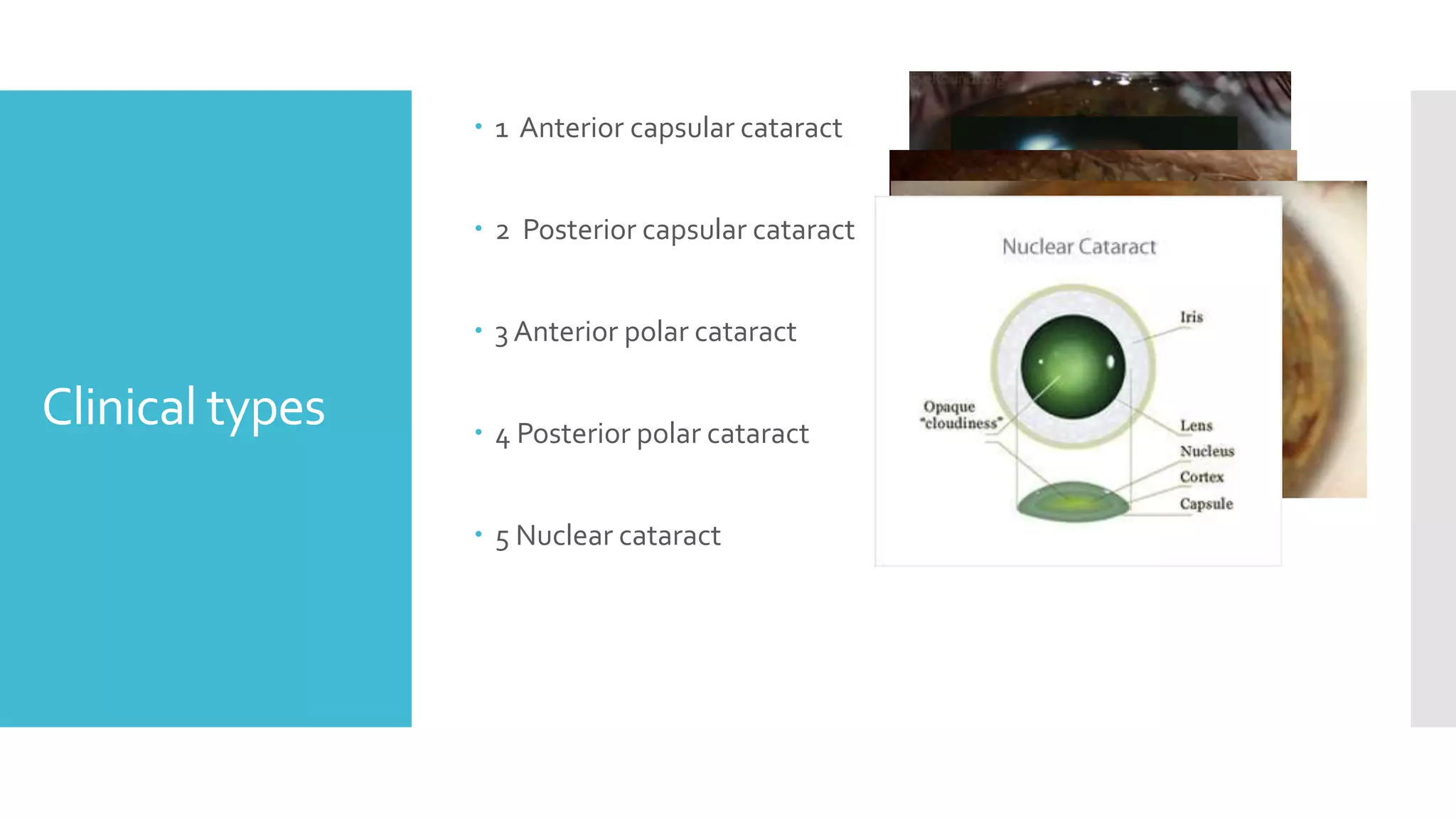 Case presentation-congenital & developmental cataract | PPTX