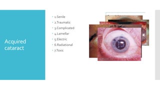 Case presentation-congenital & developmental cataract | PPTX