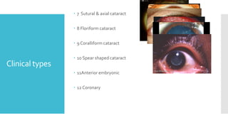 Case presentation-congenital & developmental cataract | PPTX