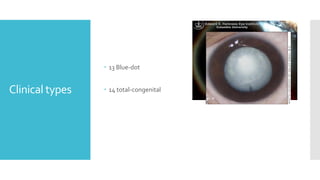 Case presentation-congenital & developmental cataract | PPTX