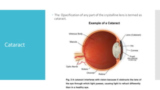 Case presentation-congenital & developmental cataract | PPTX