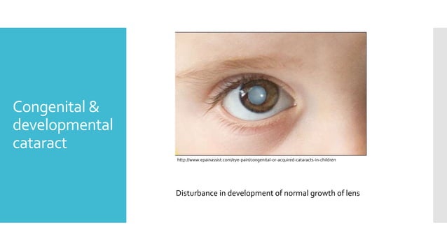Case presentation-congenital & developmental cataract | PPTX