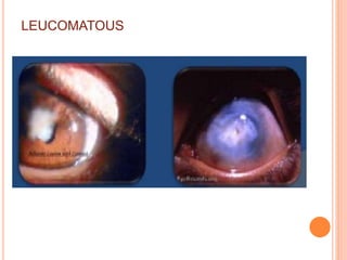 CORNEAL OPACIFICATION (Case presentation) | PPTX