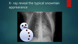 total anomalous pulmonary venous return | PPTX