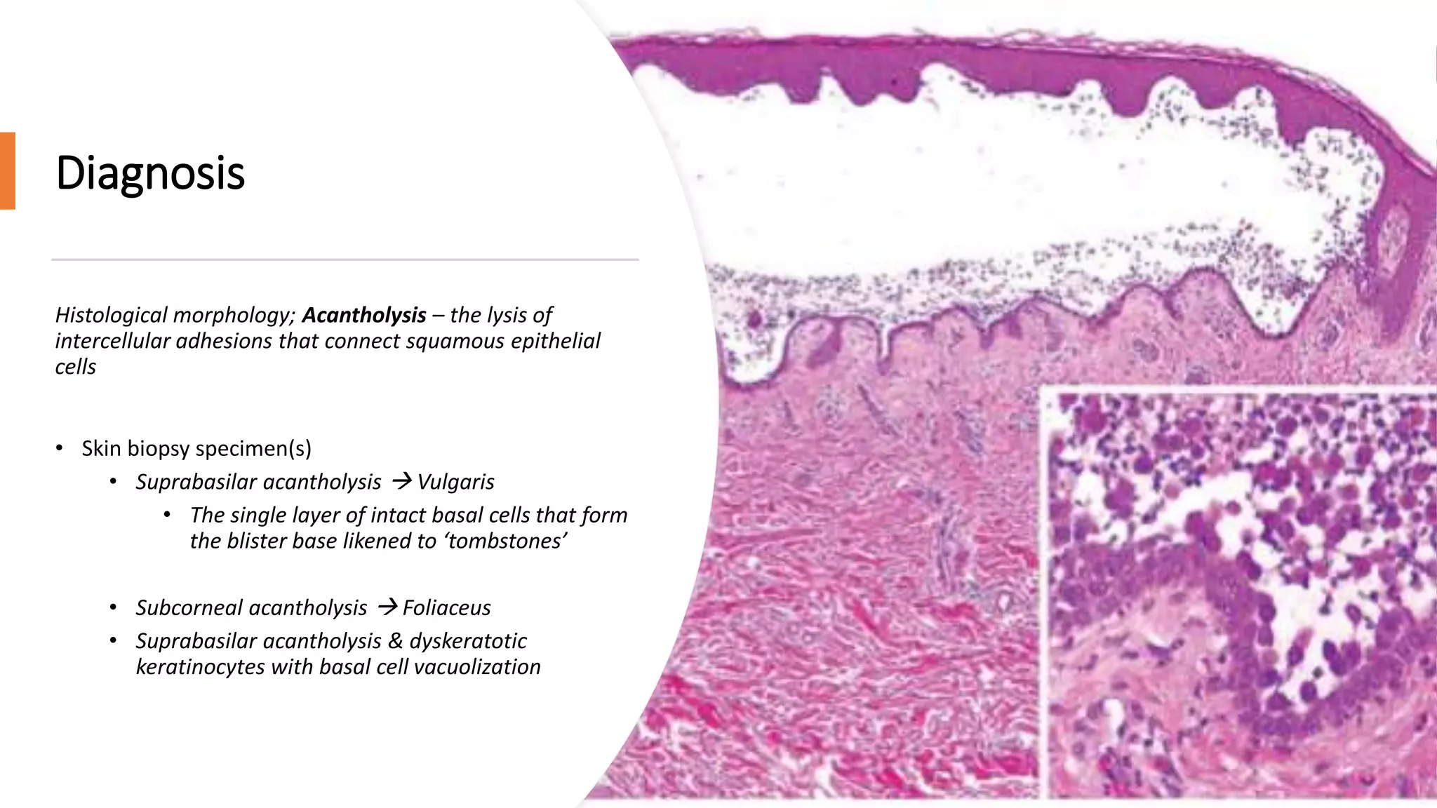 Case presentation: Pemphigus | PPTX