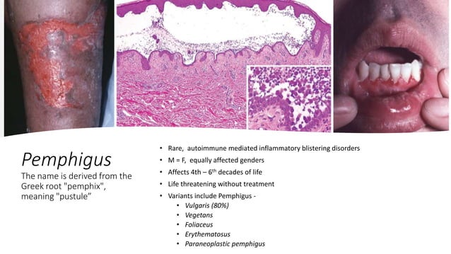Case presentation: Pemphigus | PPTX | Skin and Dermatology | Diseases ...