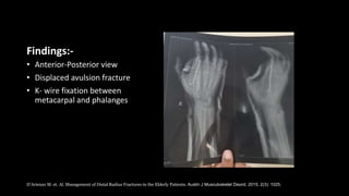 Post operative Index finger stiffness: - Case presentation.... | PPTX