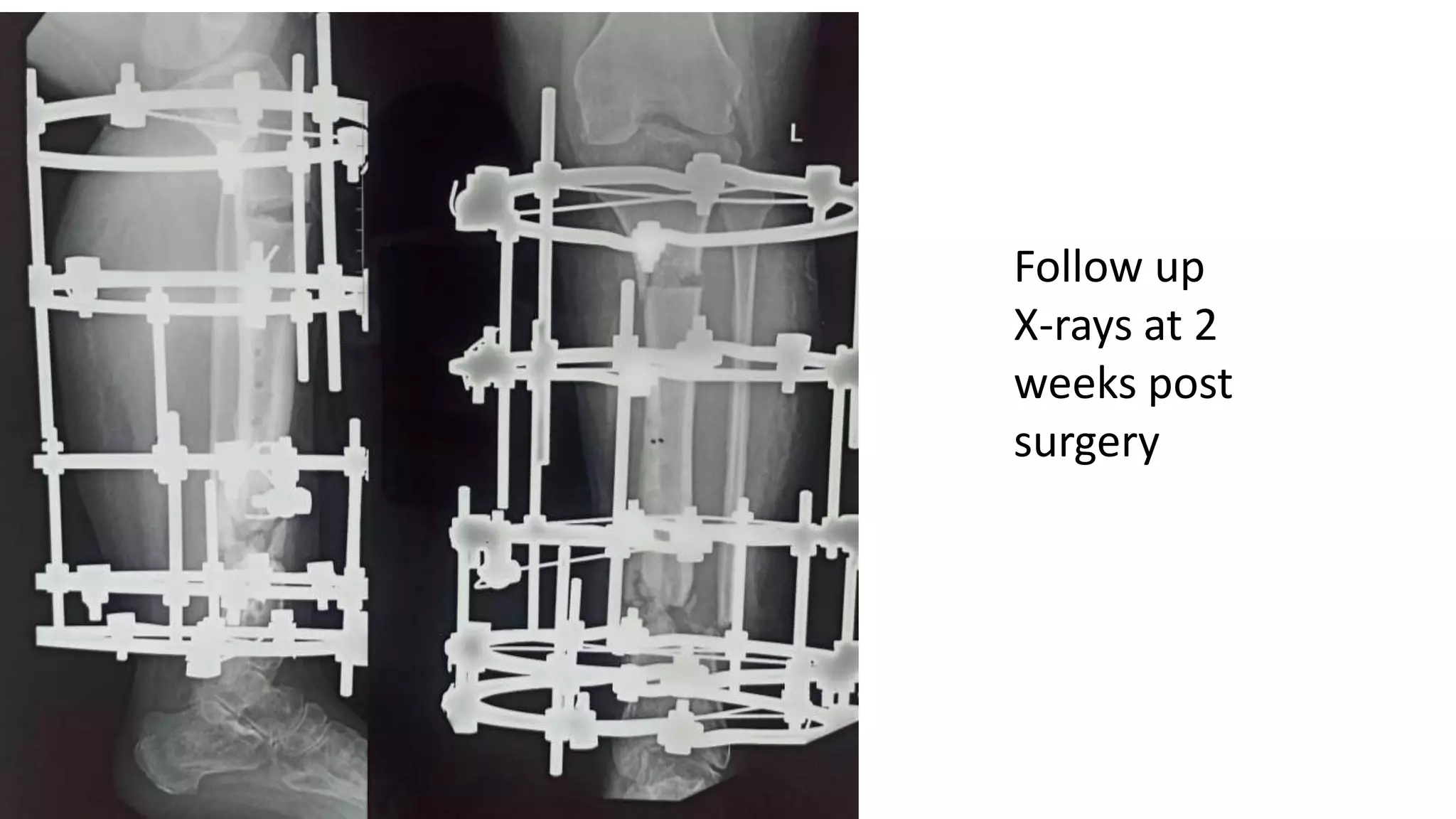 Tibia non union.pptx