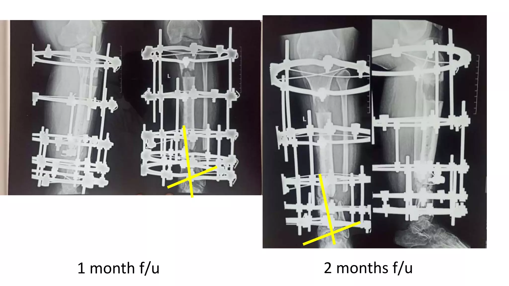 Tibia non union.pptx