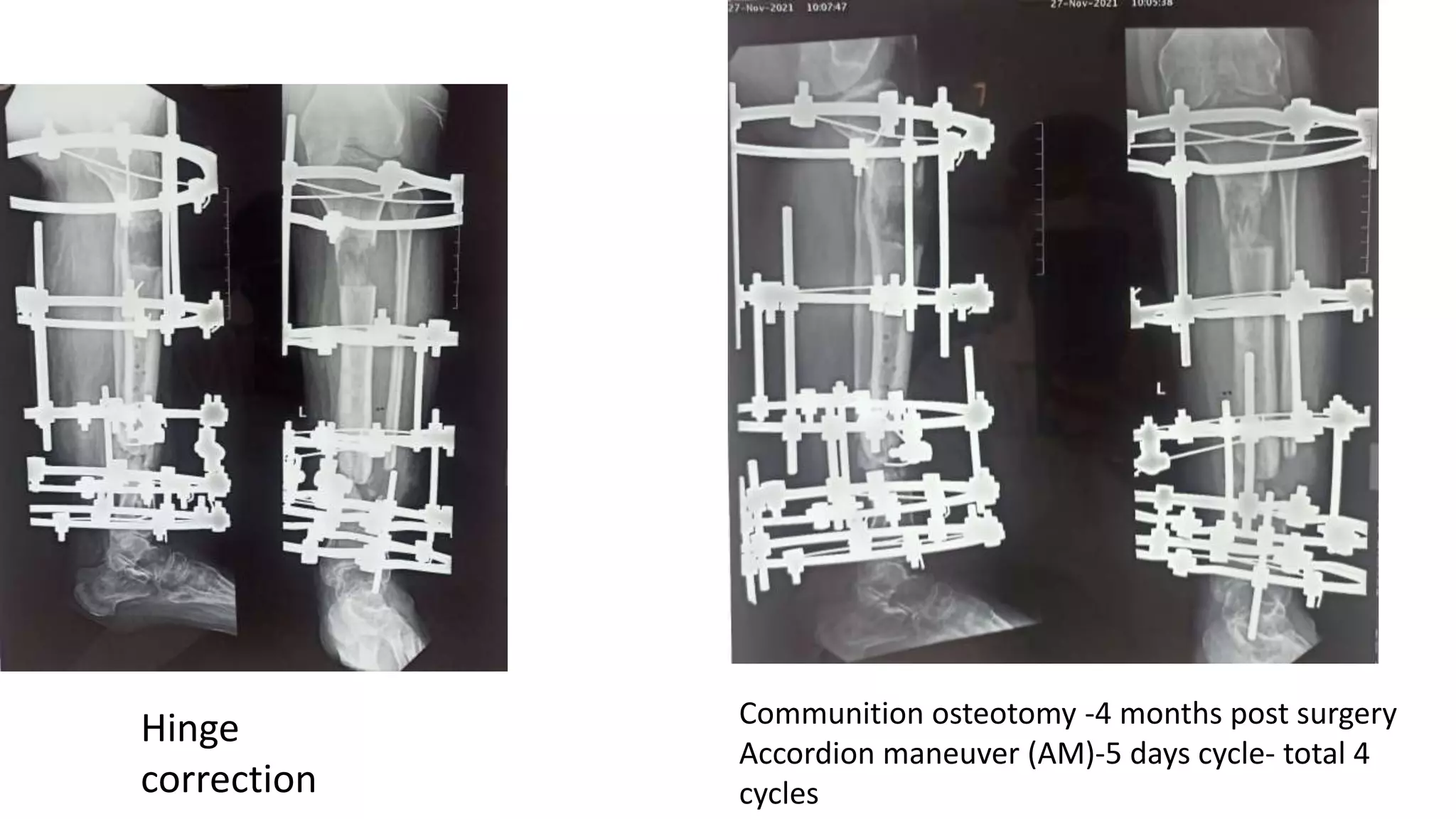 Tibia non union.pptx