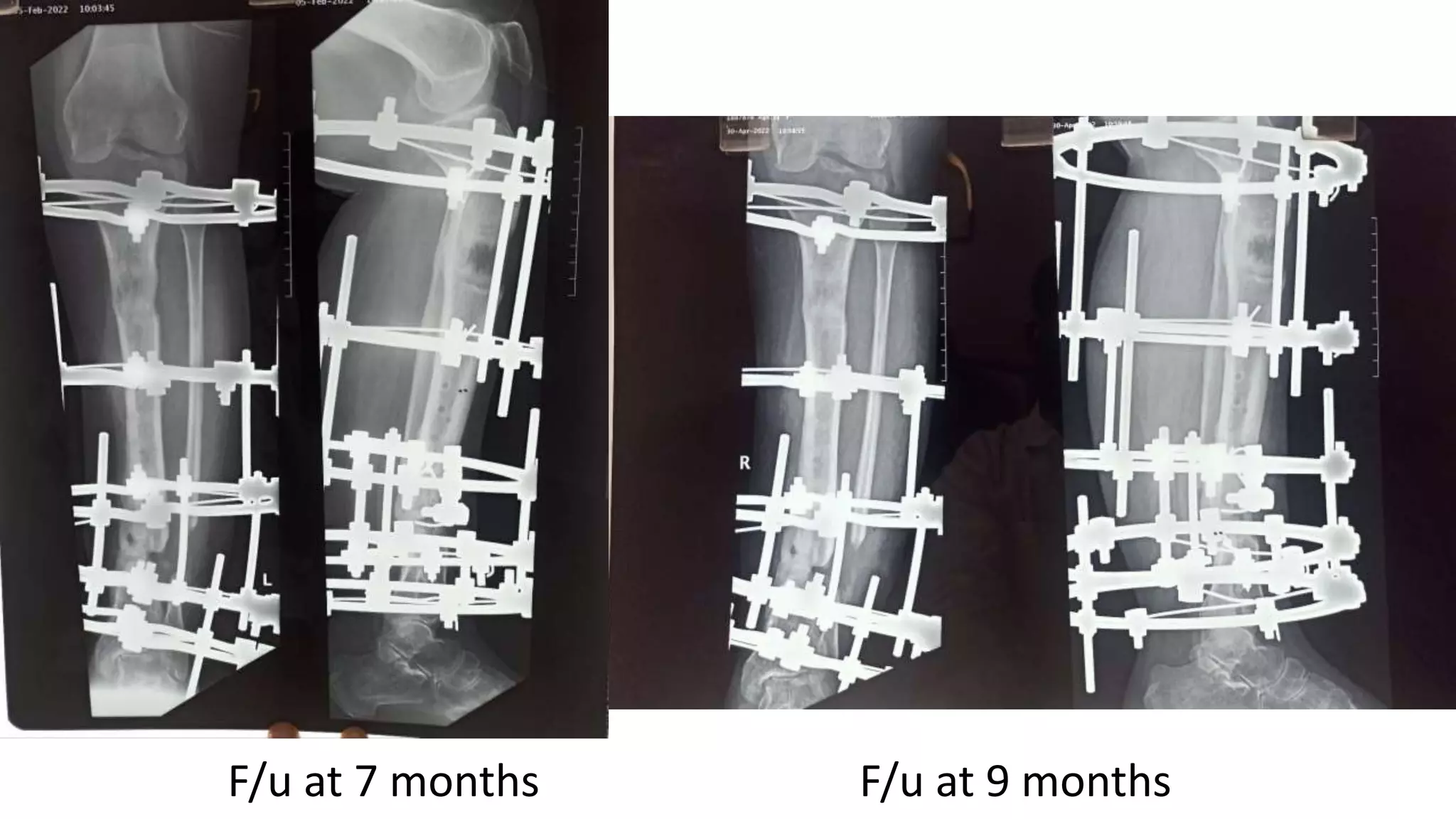 Tibia non union.pptx