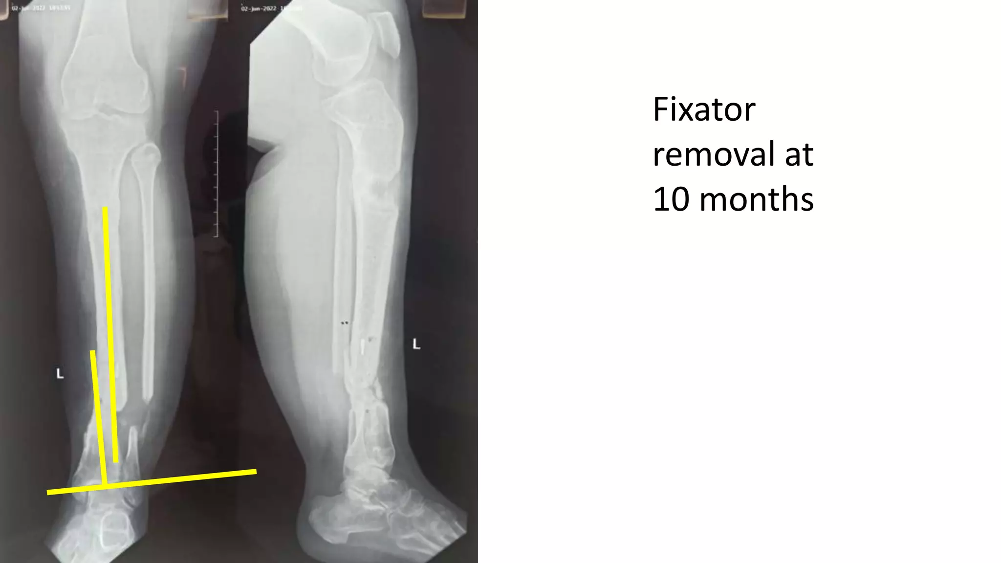 Tibia non union.pptx